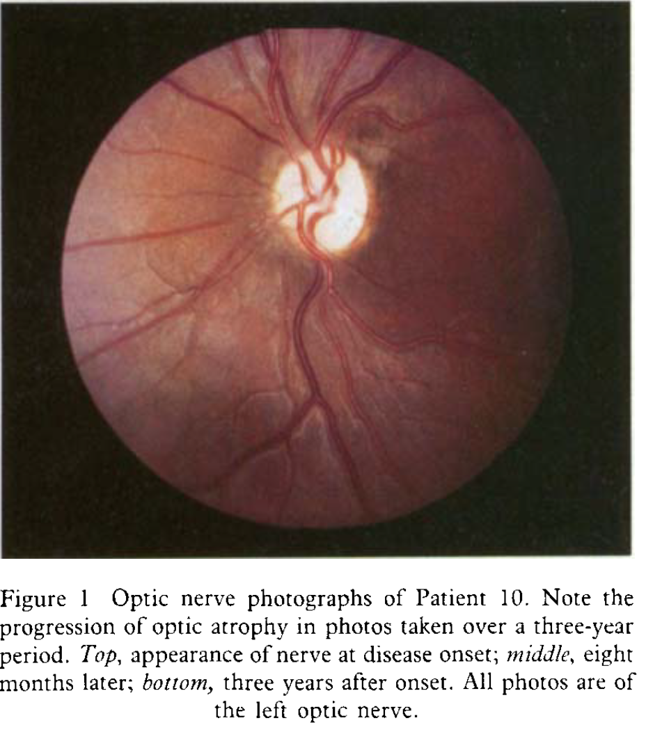 Optic neuritis in children with poor recovery of vision. | Smith ...